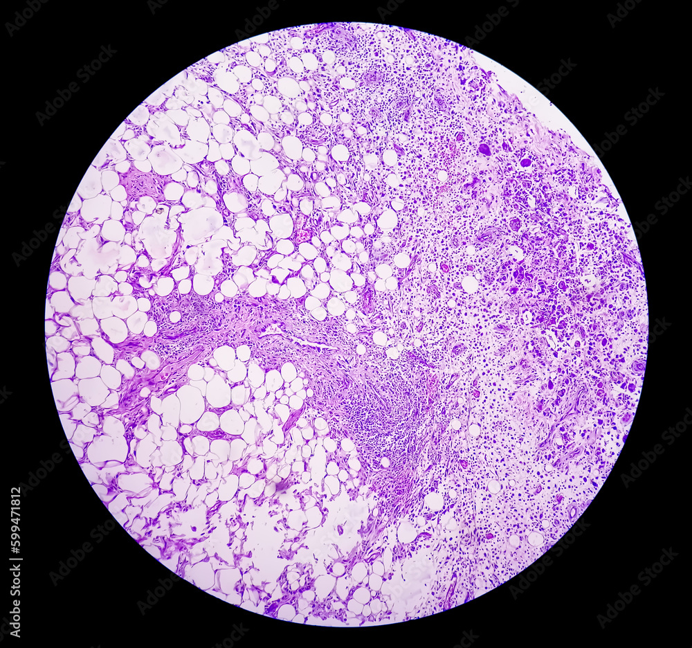 Photomicrograph of breast abscess, Granulomatous mastitis, show dense ...