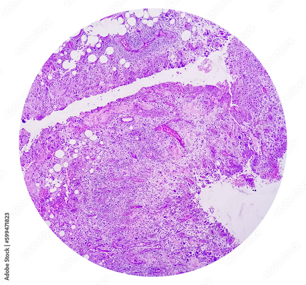 Photomicrograph of breast abscess, Granulomatous mastitis, show dense ...