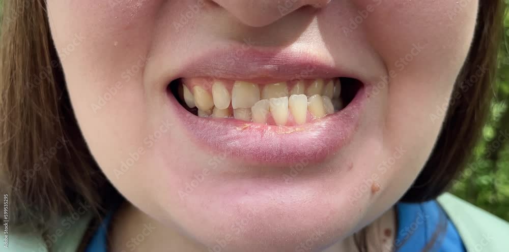 Patient with dislocated jaw and malocclusion, temporomandibular joint ...