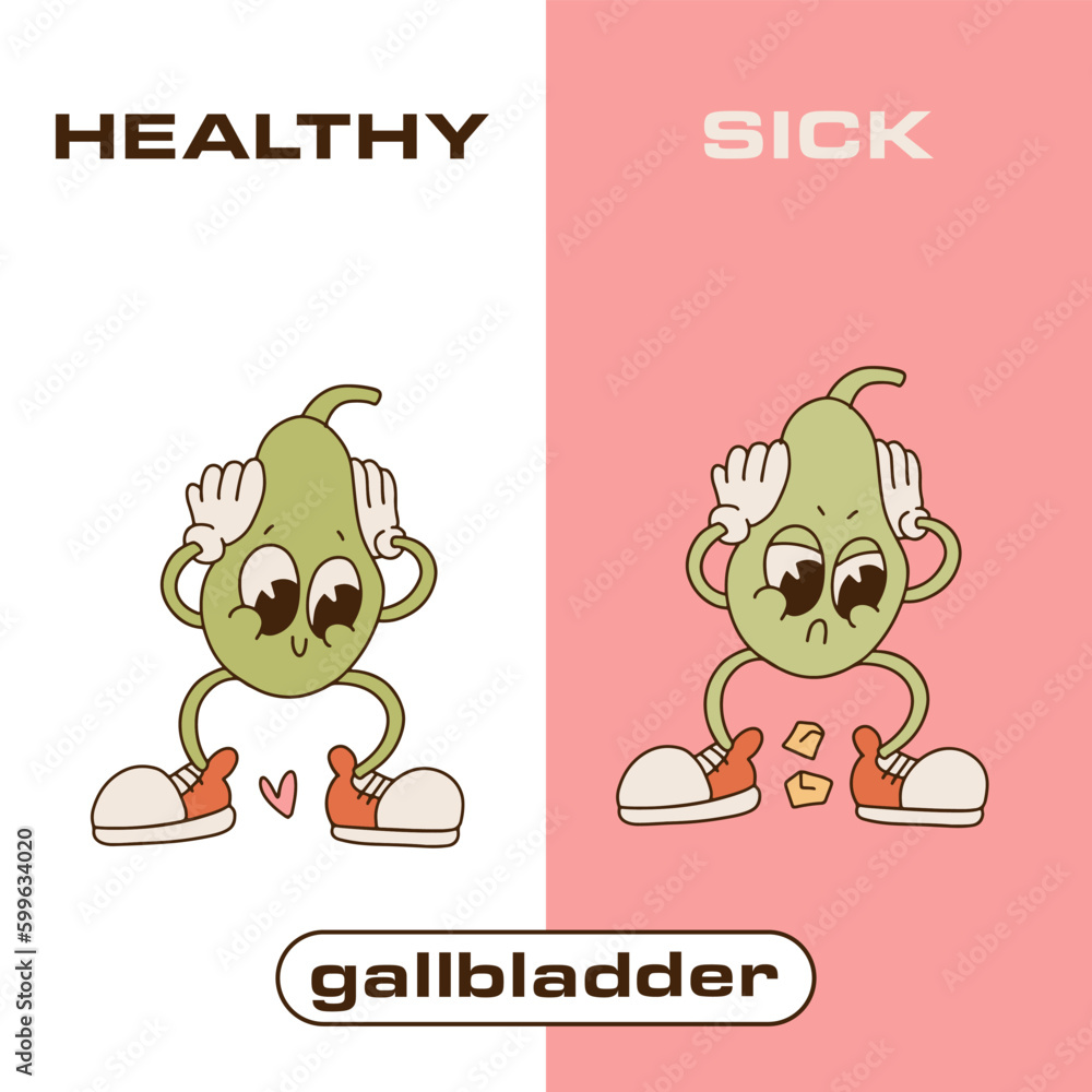 Happy healthy gallbladder vs sick sad gallbladder with stones. Retro ...