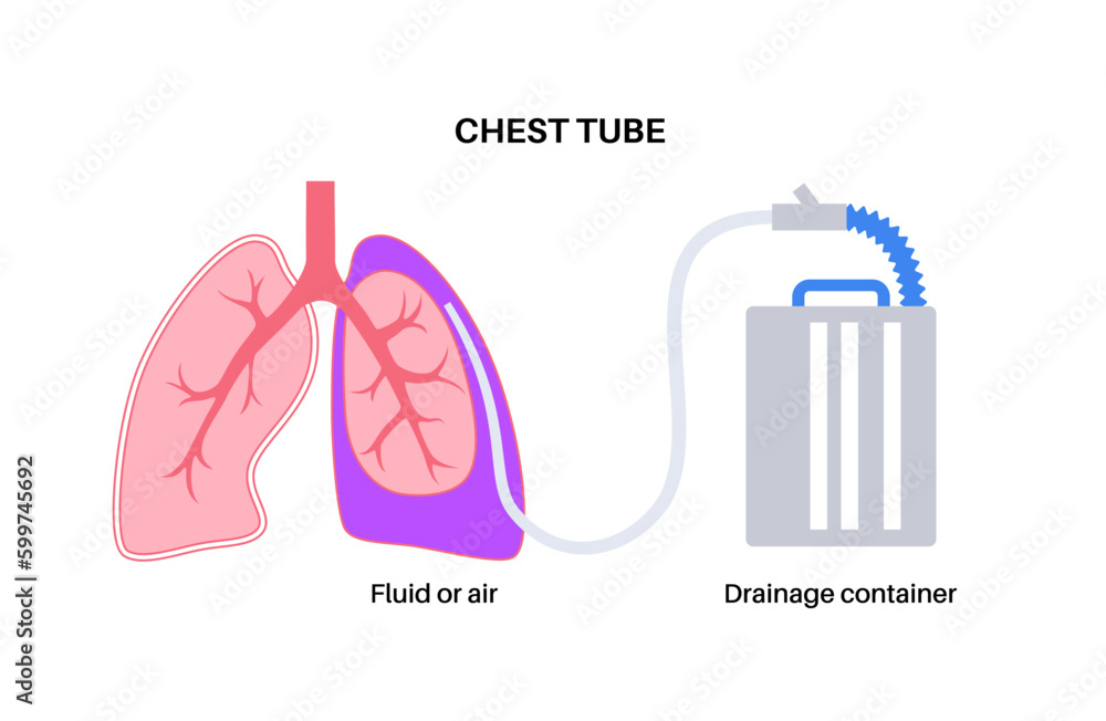 Chest tube catheter Stock Vector | Adobe Stock