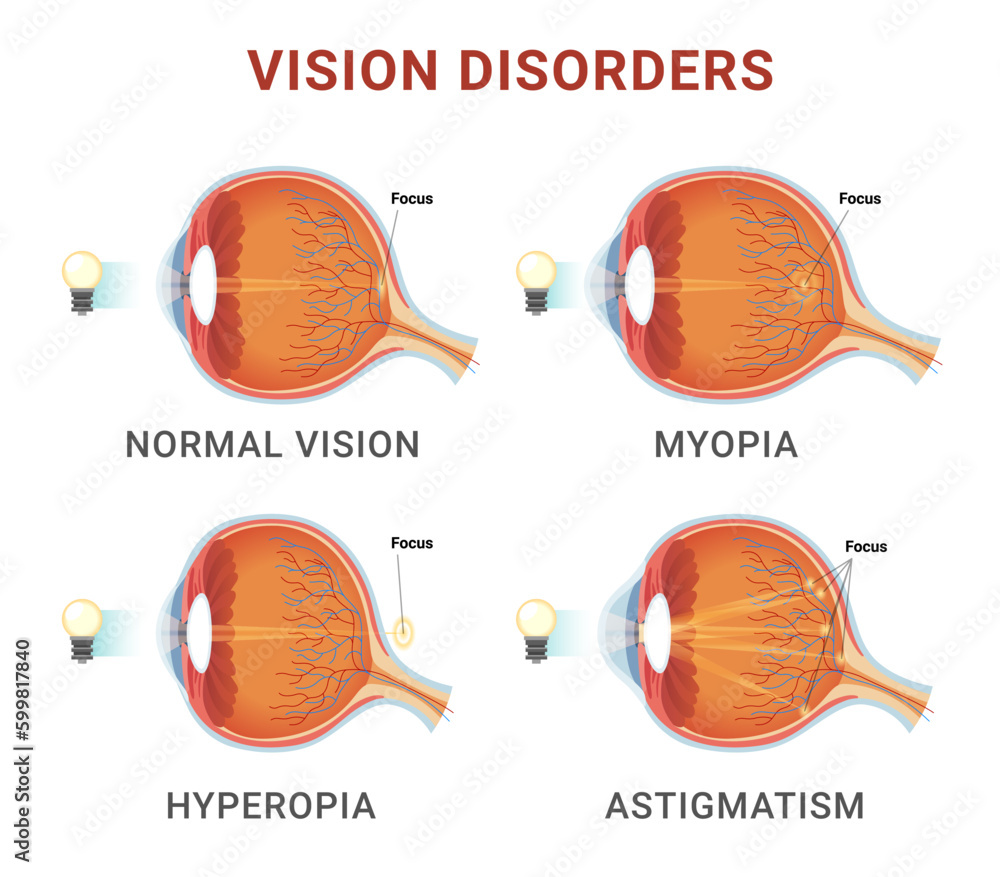Vision disorders medical education scheme with names and eyeball ...