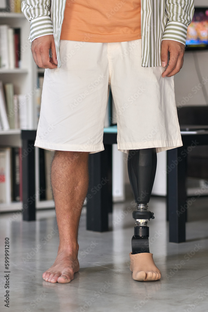 Man amputee with prosthetic leg disability on above knee transfemoral ...