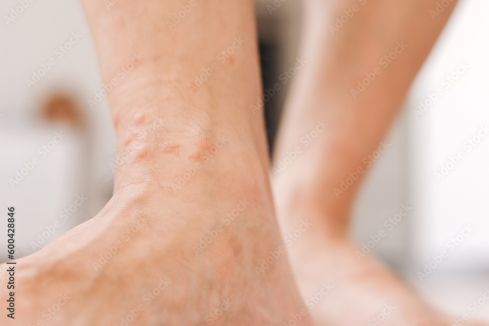 Close up allergic rash dermatitis eczema on man foot. Leg with red rash ...