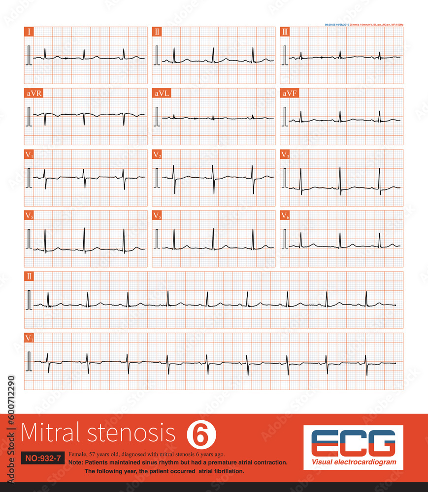 Female, 57 years old, diagnosed with mitral stenosis 6 years ago. When ...