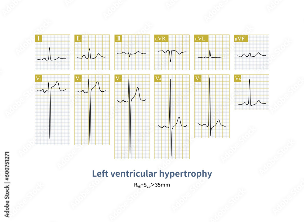 Male, 48 years old, clinically diagnosed with dilated cardiomyopathy ...