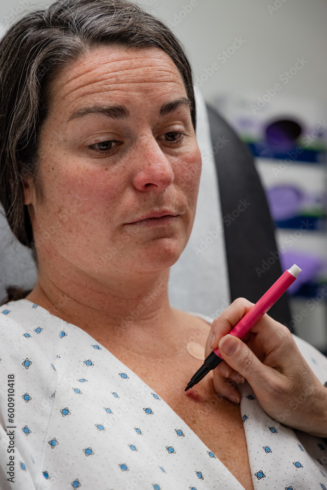 Dermatologist about to draw line on young 30s woman for basal cell ...