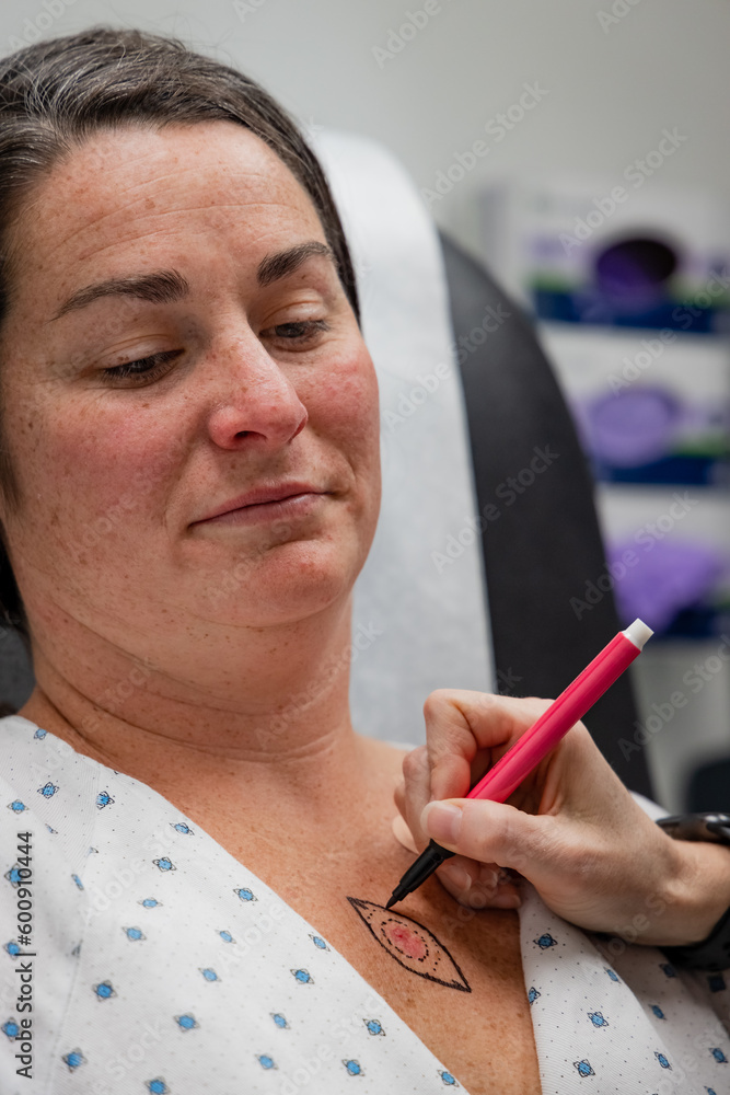Dermatologist consults patient after drawing on young 30s woman chest ...