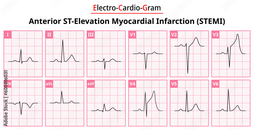 Anterior STEMI (ST-Elevation Myocardial Infarction) - The Differences ...