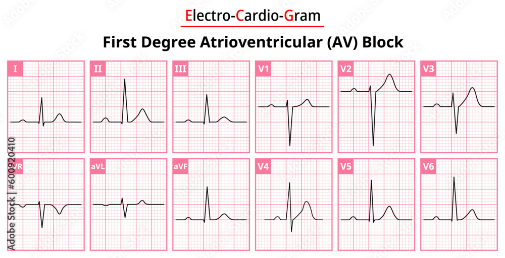 First Degree AV (Atrioventricular) Block - The Differences in ECG ...