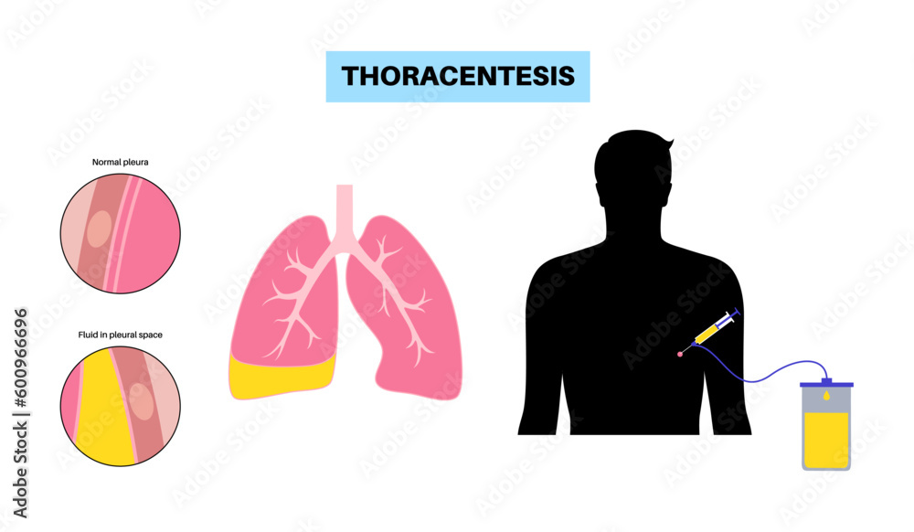 Thoracentesis medical procedure Stock Vector | Adobe Stock