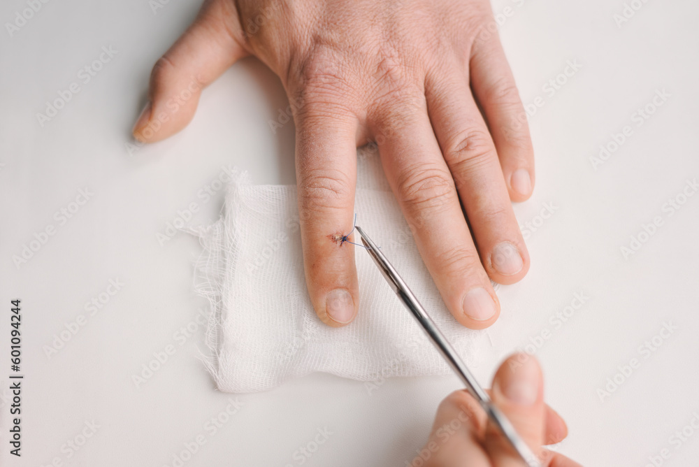 Removal of suture on finger of patient in clinic. Inspection of seam on ...