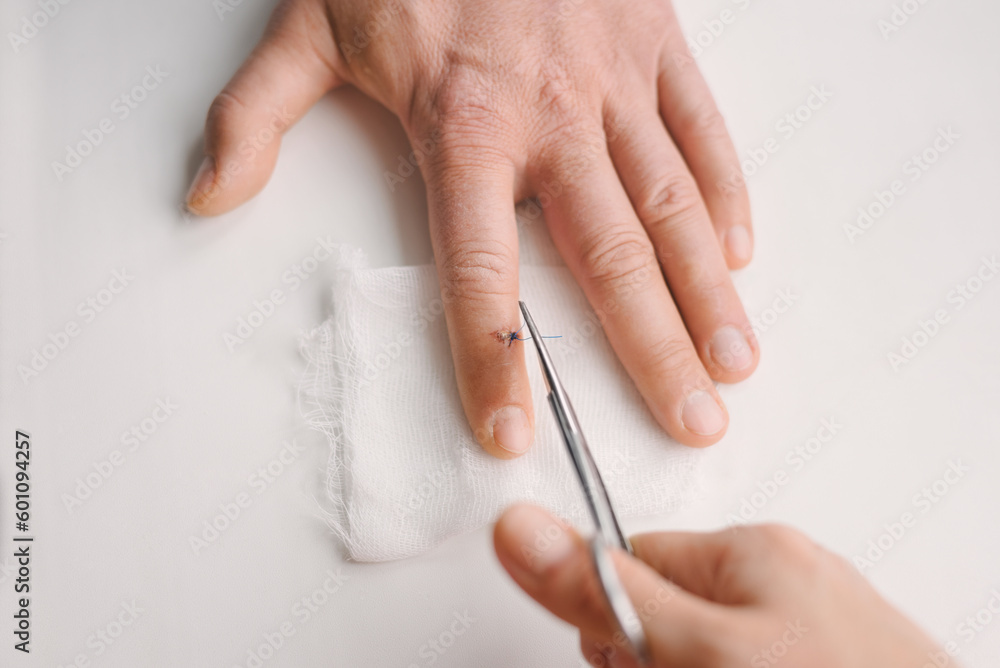 Removal of suture on finger of patient in clinic. Inspection of seam on ...