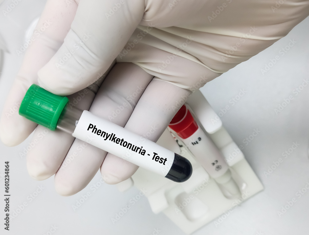 Blood sample for Phenylketonuria (PKU) test, is an inherited disorder ...
