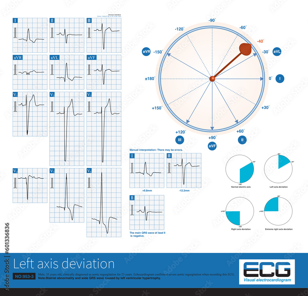 This is an electrocardiogram of left ventricular hypertrophy with left ...