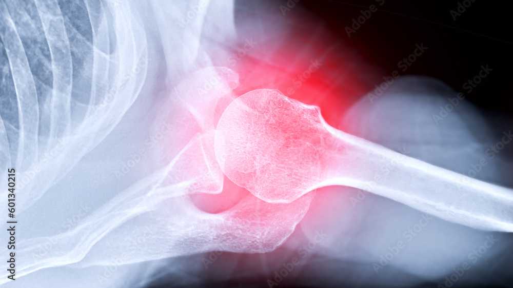 X-ray Shoulder joint shoulder transaxillary view for diagnosis fracture ...