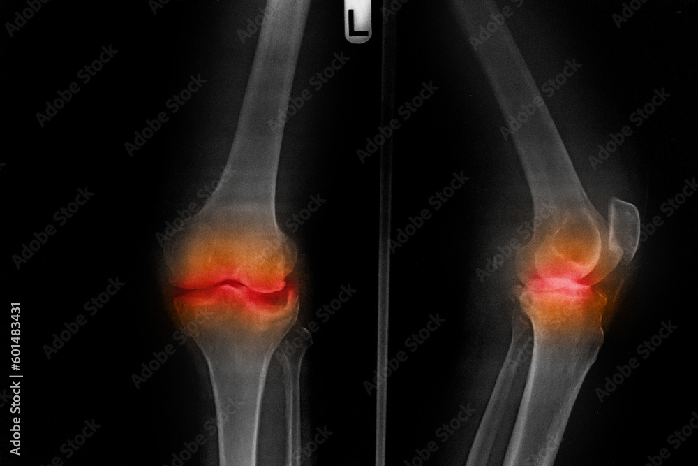 Osteoarthritis Left knee film x-ray AP (anterior - posterior) of knee ...