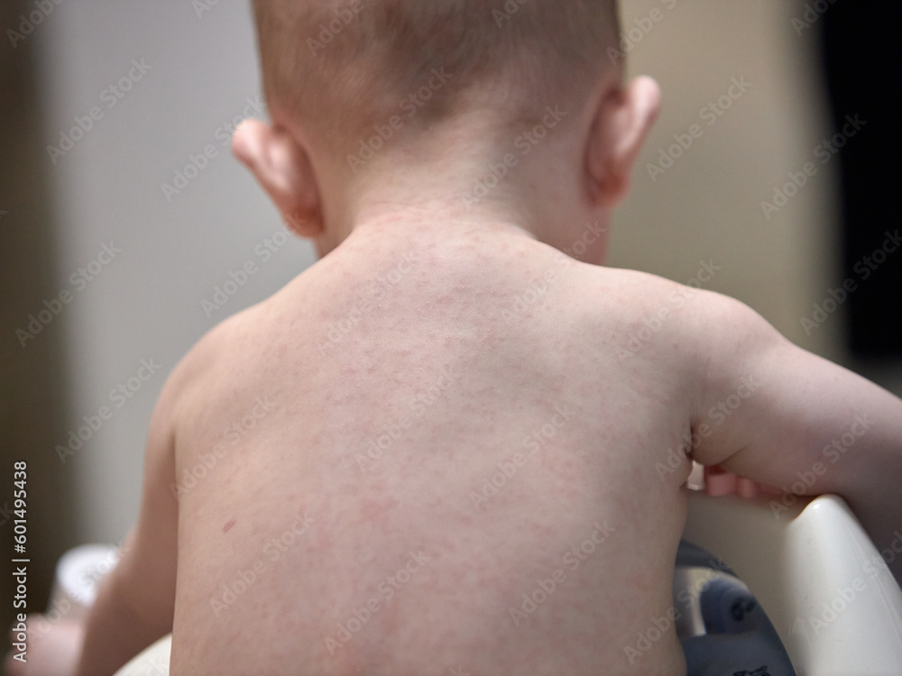 roseola rash a viral rash on the skin of a child Stock Photo | Adobe Stock