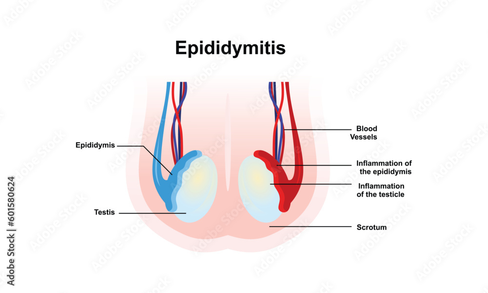 Epididymitis Is Inflammation Of The Epididymis Of The Testicle Stock