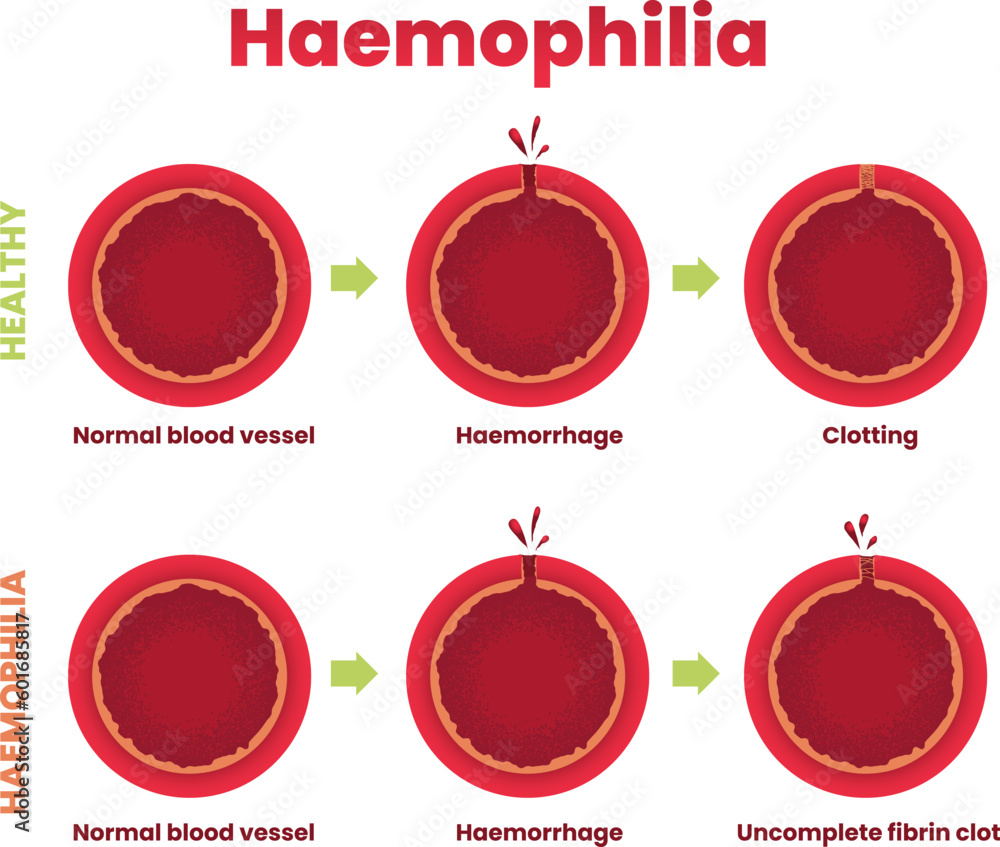 illustration of haemophilia, healthy blood vessel vs haemophilia infographic Stock Vector ...