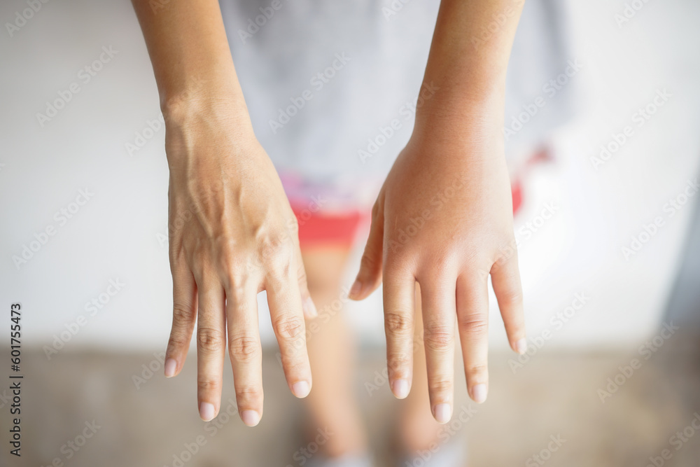 Close-up comparison of woman's hand swollen from insect bites. Top view ...