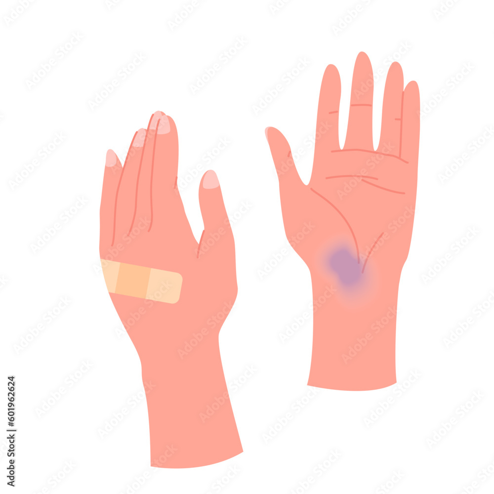 Human hands with band aid, bruise on palm, infographic vector ...
