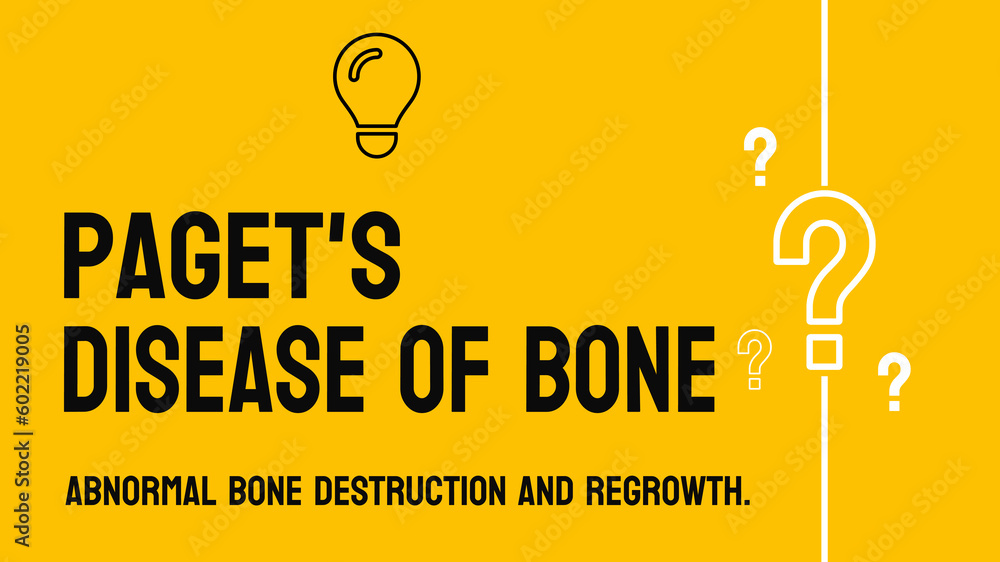Paget's Disease of Bone: A bone disorder causing abnormal bone growth ...