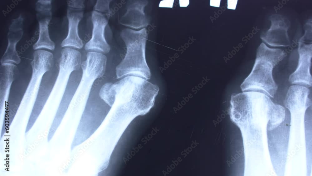 Doctor hands with blue medical x ray scan of feet and toes with Hallux ...