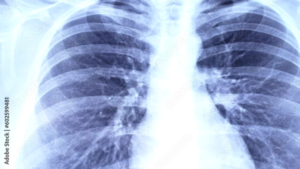 Blue medical x ray of chest scan on light background. Covid desease ...