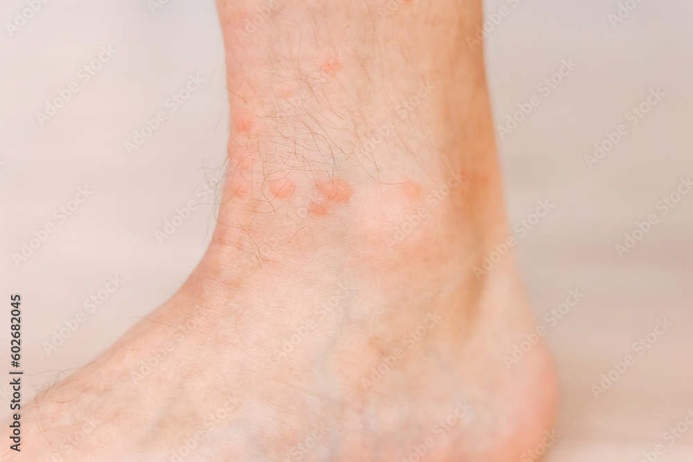Close up allergic rash dermatitis eczema on man foot. Leg with red rash ...