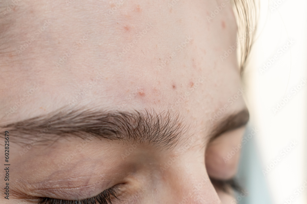 the face of a teenage boy with acne and acne. red rashes on the skin ...