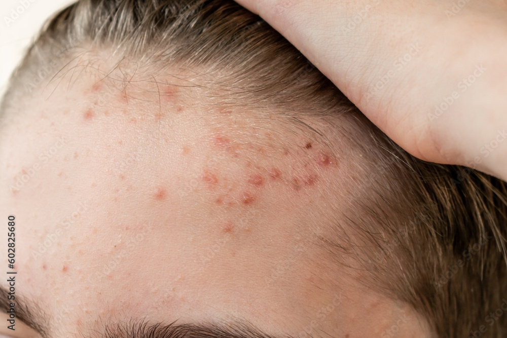 the face of a teenage boy with acne and acne. red rashes on the skin ...