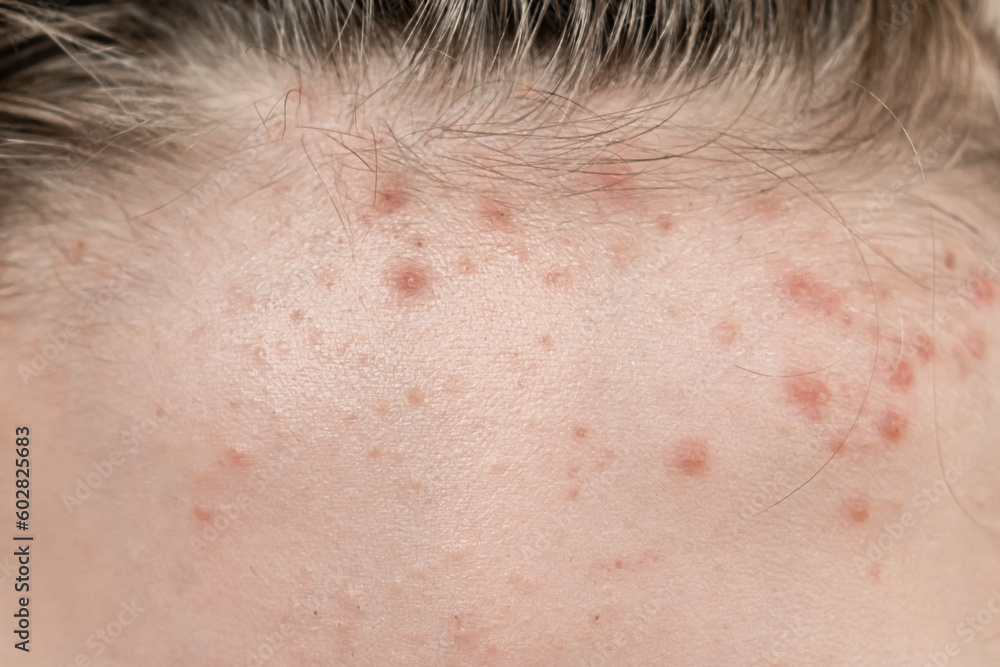 Foto de the face of a teenage boy with acne and acne. red rashes on the ...