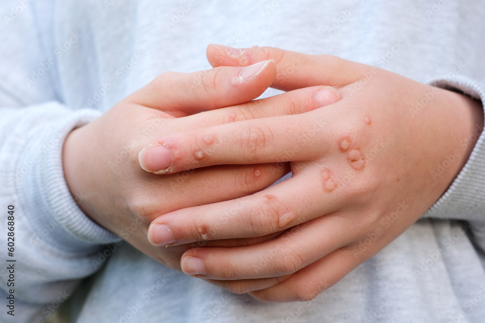 Hand with wart man skin closeup hands of young teenage girl are strewn ...