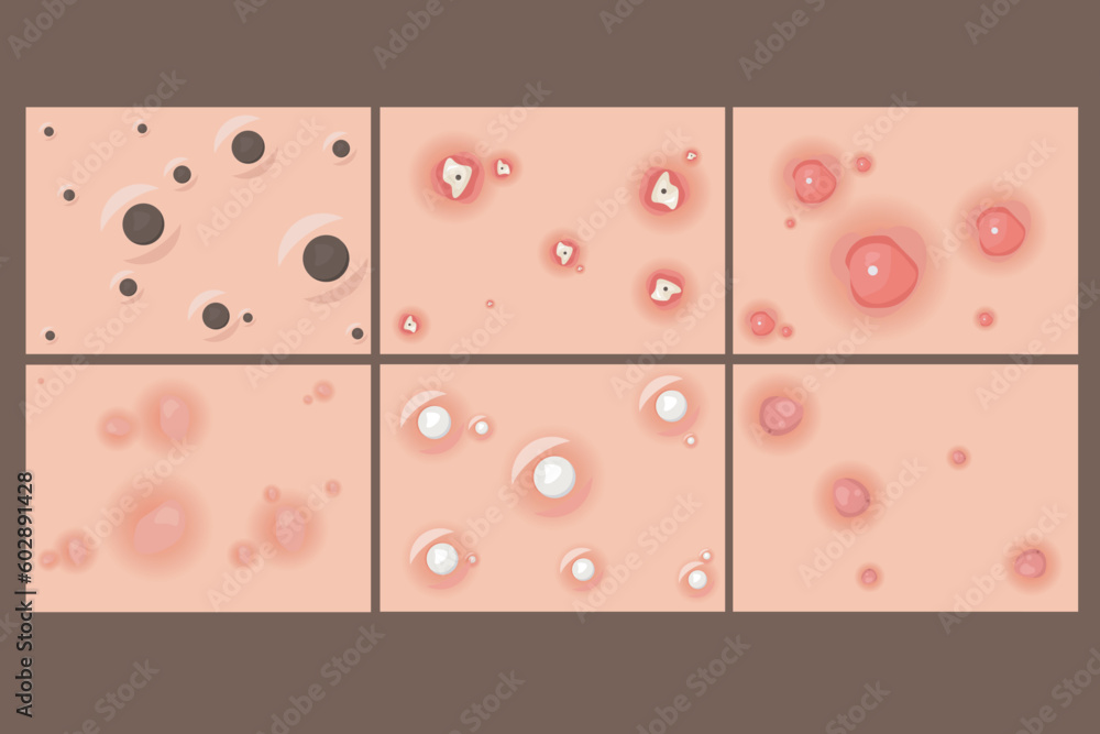 vector collection of types of pimples inside the skin Facial infections ...