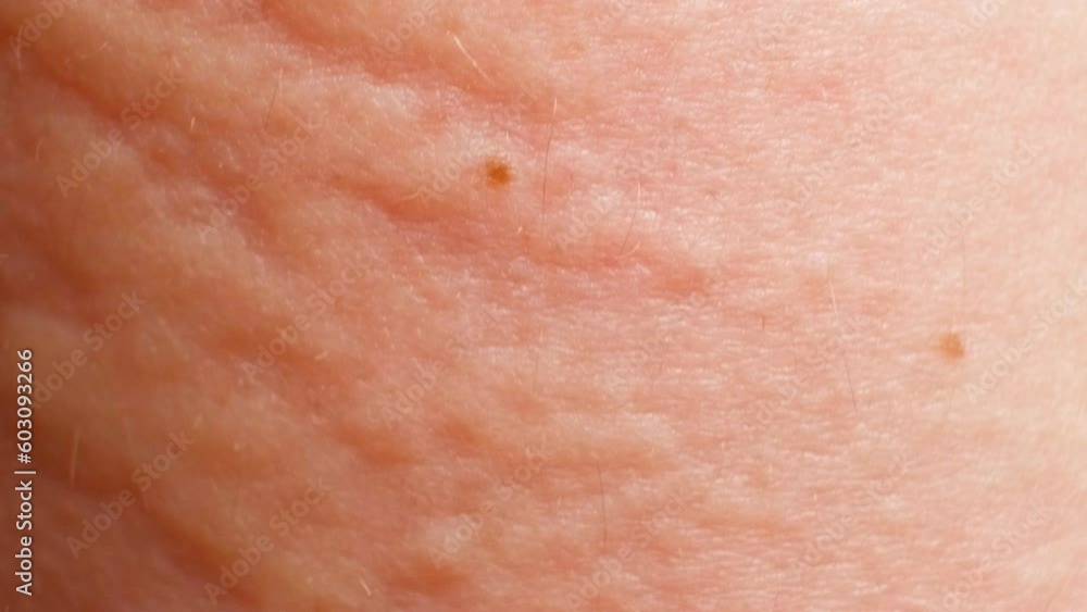 Video „Blisters due to giardia on the reddened skin of the hand close ...