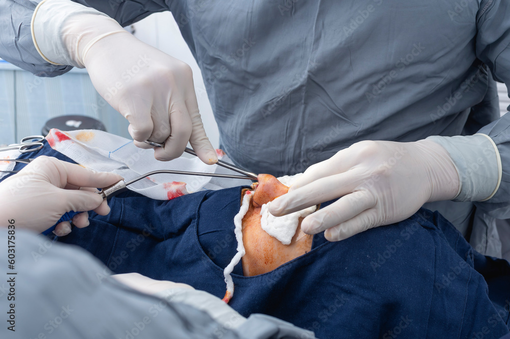 A cosmetic surgeon cuts and separates the flap of skin of the nose from ...