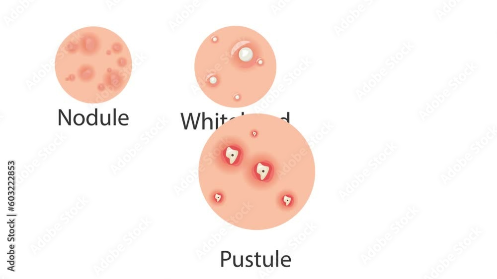 6 types of pimples on human face skin 4k animation white background ...