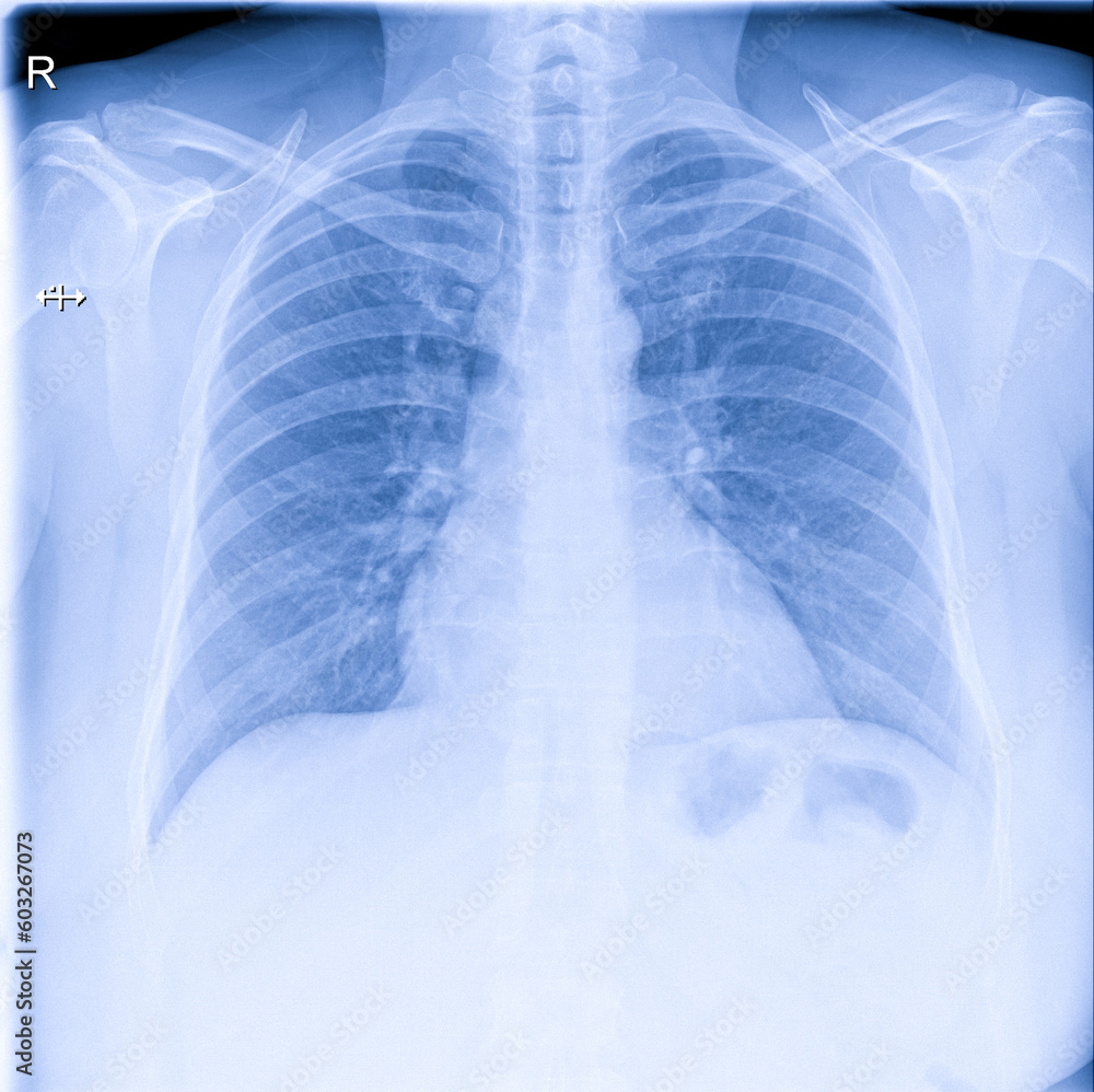 X-Ray Image Of Human Chest for a medical diagnosis Stock Photo | Adobe ...