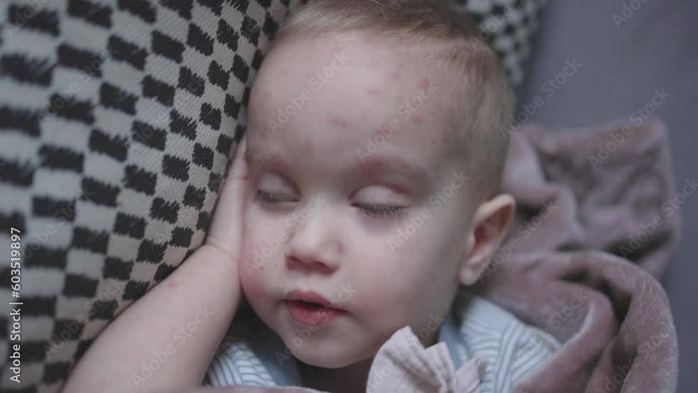 sick baby toddler child suffering from chickenpox symptoms lying sofa fever pimples blister face ...