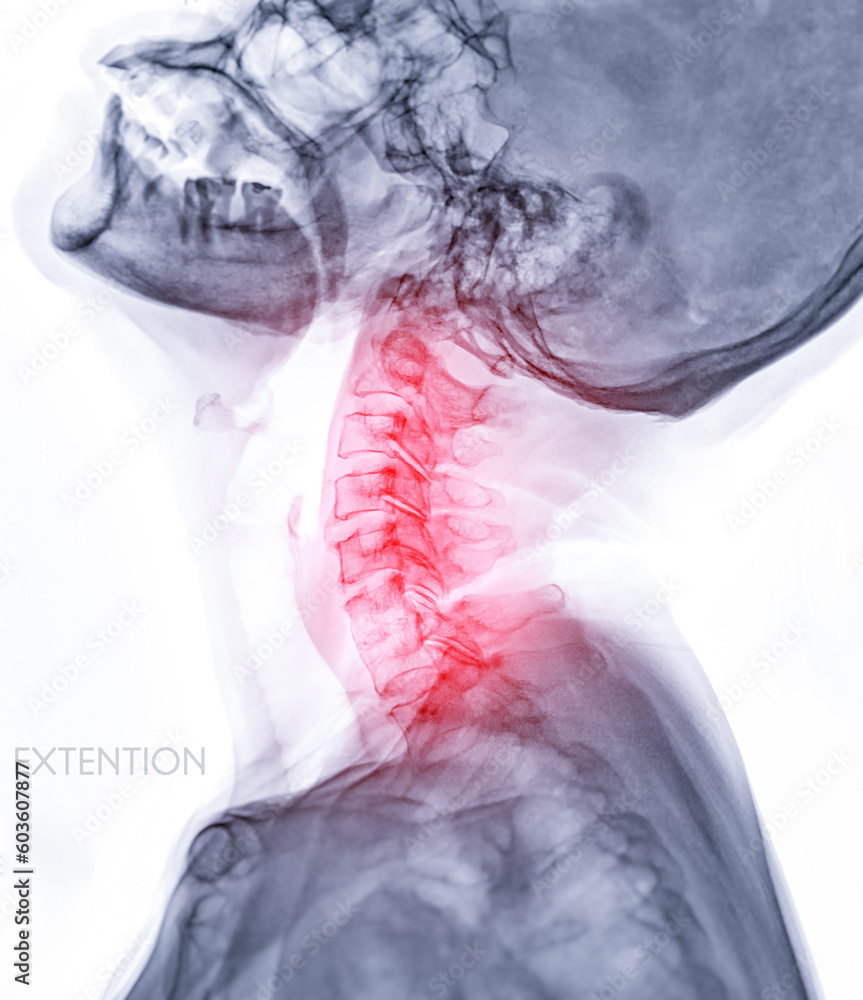 X-ray C-spine or x-ray image of Cervical spine Extension viewfor ...