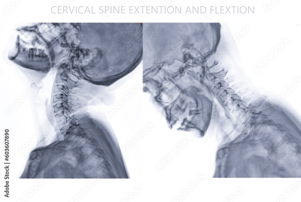 X-ray C-spine or x-ray image of Cervical spine Flexion and Extension ...