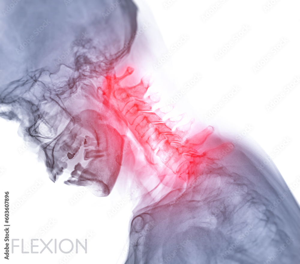 X Ray C Spine Or X Ray Image Of Cervical Spine Flexion View For Diagnostic Intervertebral Disc
