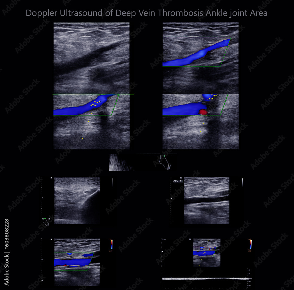 Color Doppler ultrasound determination in deep vein thrombosis patients ...