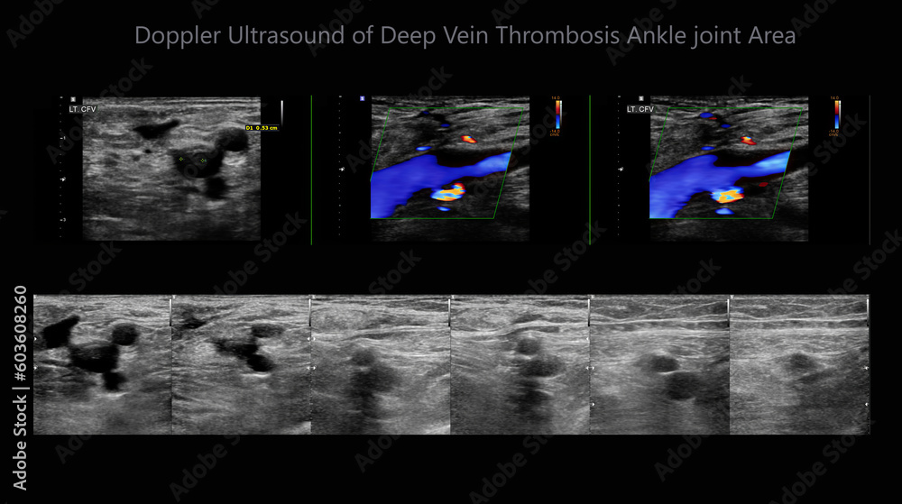 Poster Color Doppler ultrasound determination in deep vein thrombosis ...