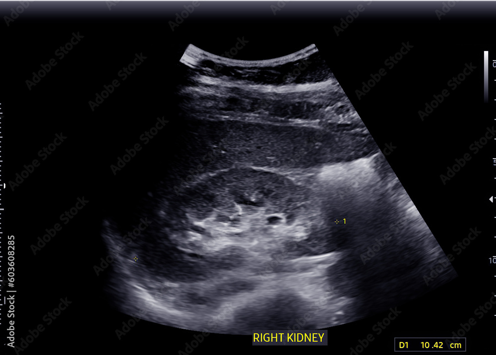 Ultrasound of Kidney or KUB for screening renal stone disease. Stock ...