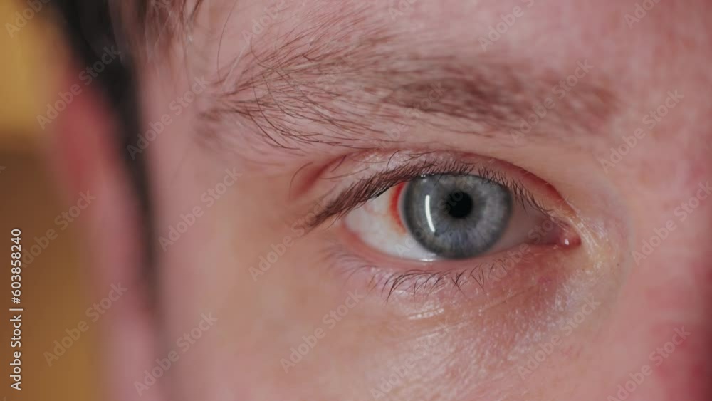 Eye injury Close up, blood in eye damage by an injury. Hemorrhage of ...