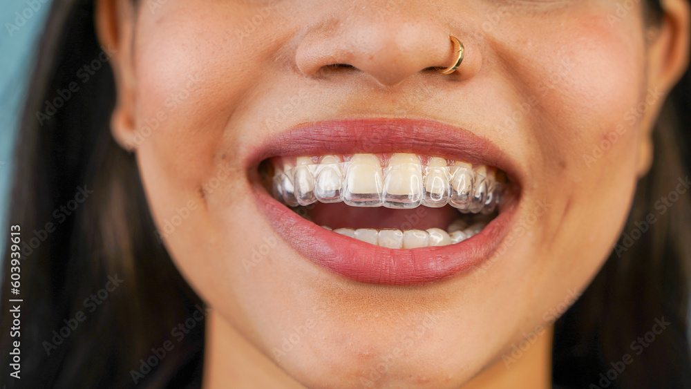 Young Asian Indian woman holding removable invisible aligner, also ...