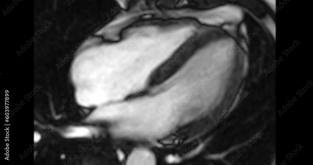 MRI heart or Cardiac MRI ( magnetic resonance imaging ) of heart ...