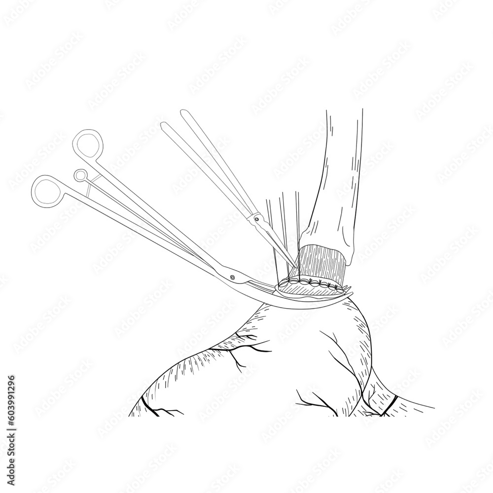 Gastroesophageal anastomosis surgery.This medical illustration shows ...
